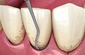 Periodontal Therapy DeLand, FL | Gum Disease | Oral Health