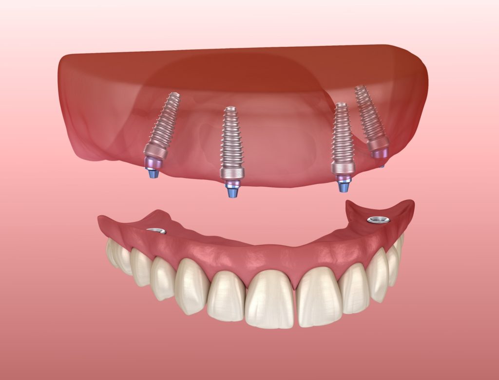 Does Adding Dental Implants to Dentures Really Make a Difference?